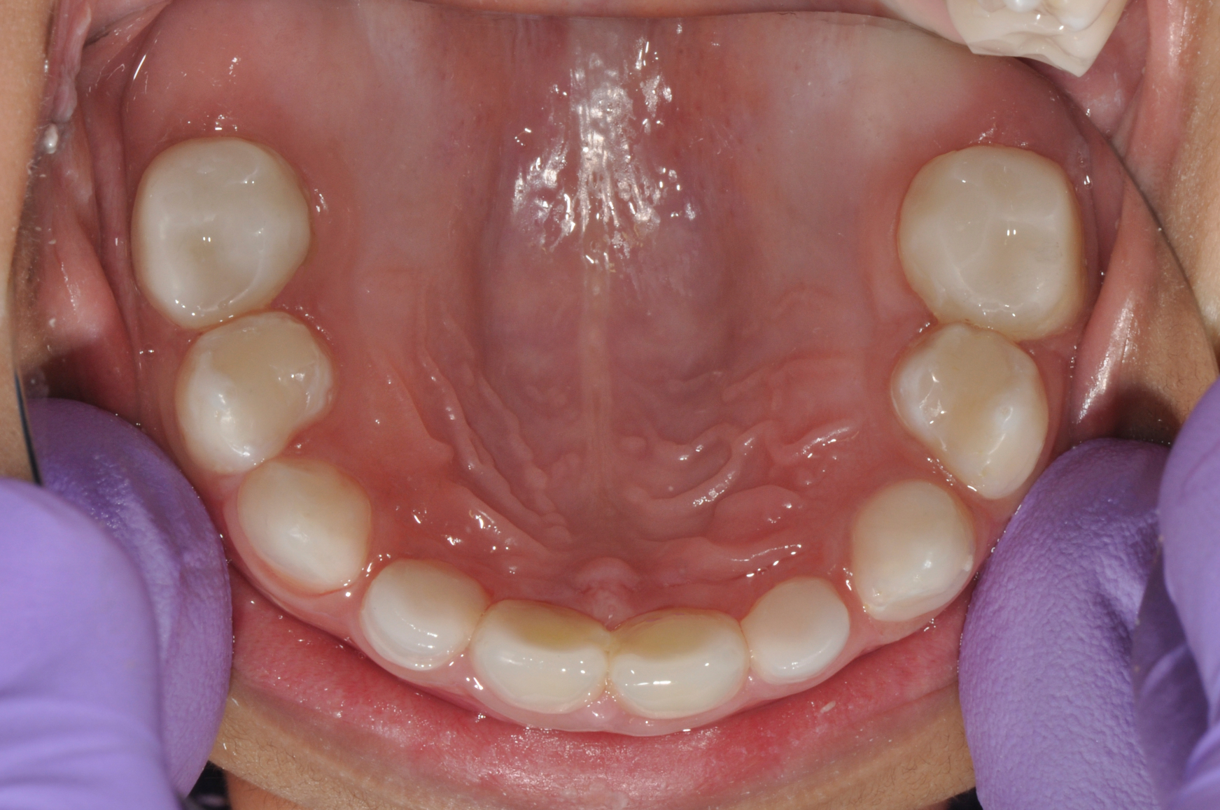 Edelweiss PEDIATRIC CROWNs: A new and innovative approach to restoring ...