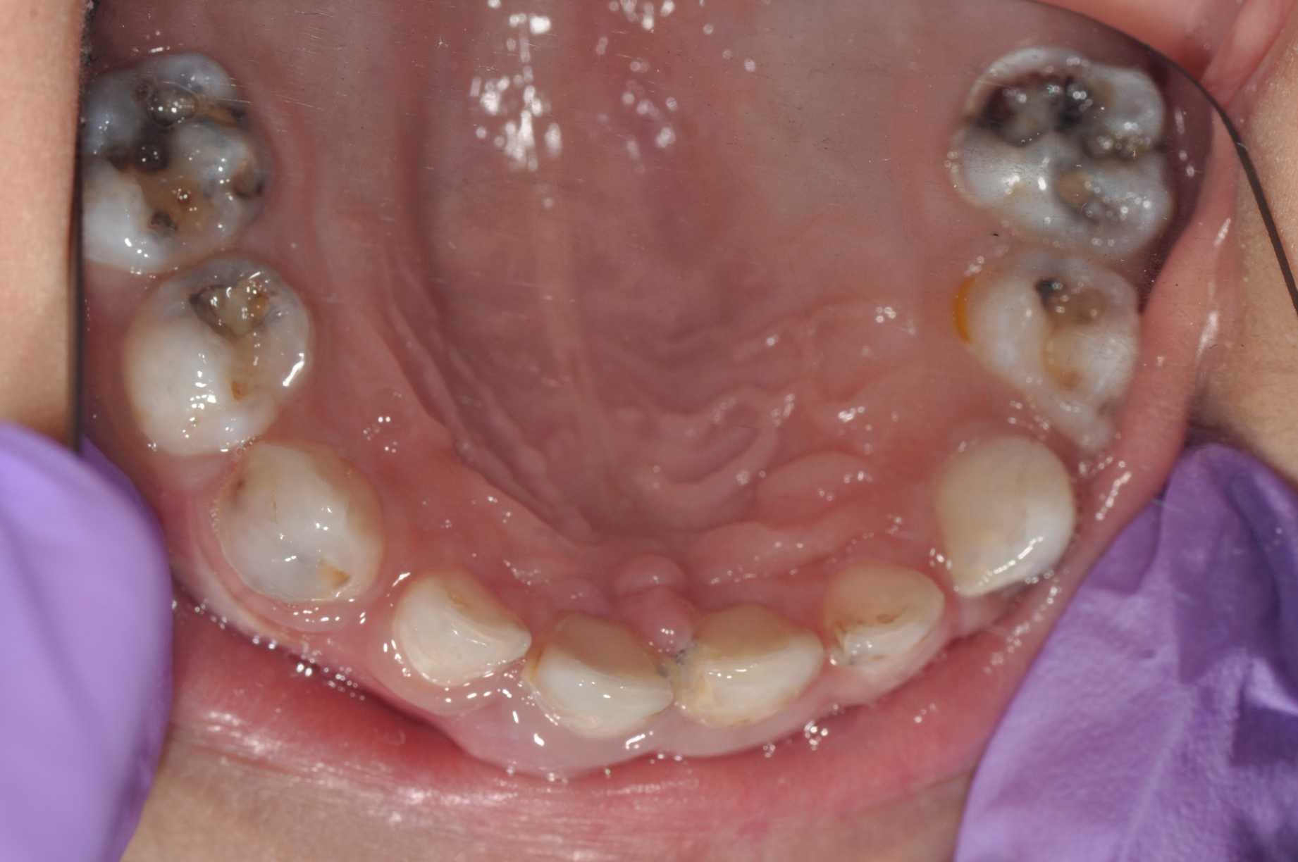 Edelweiss PEDIATRIC CROWNs: A new and innovative approach to restoring ...